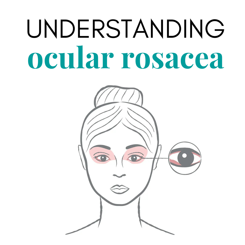 Ocular Rosacea: Top Causes, Best Treatments, and Why We Love Eyes Is Y
