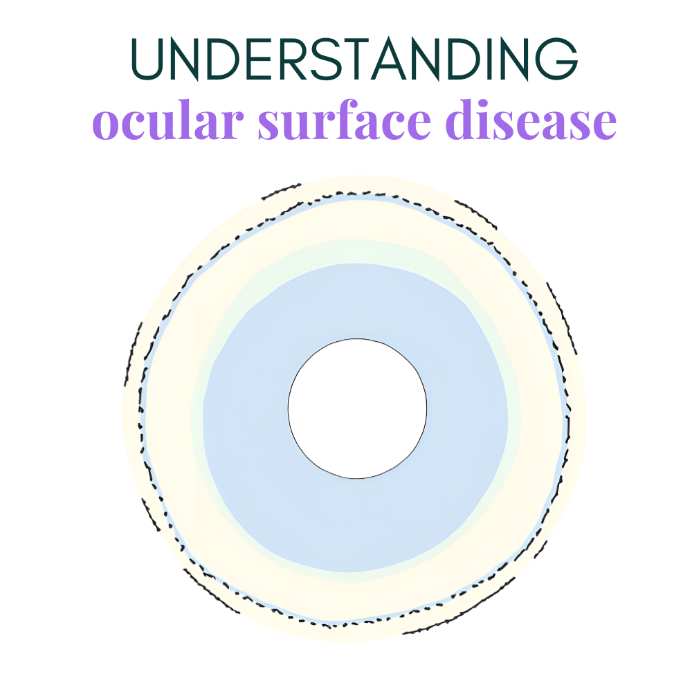 Understanding OCULAR SURFACE DISEASE: How to Combat Dry, Itchy Eyes an ...