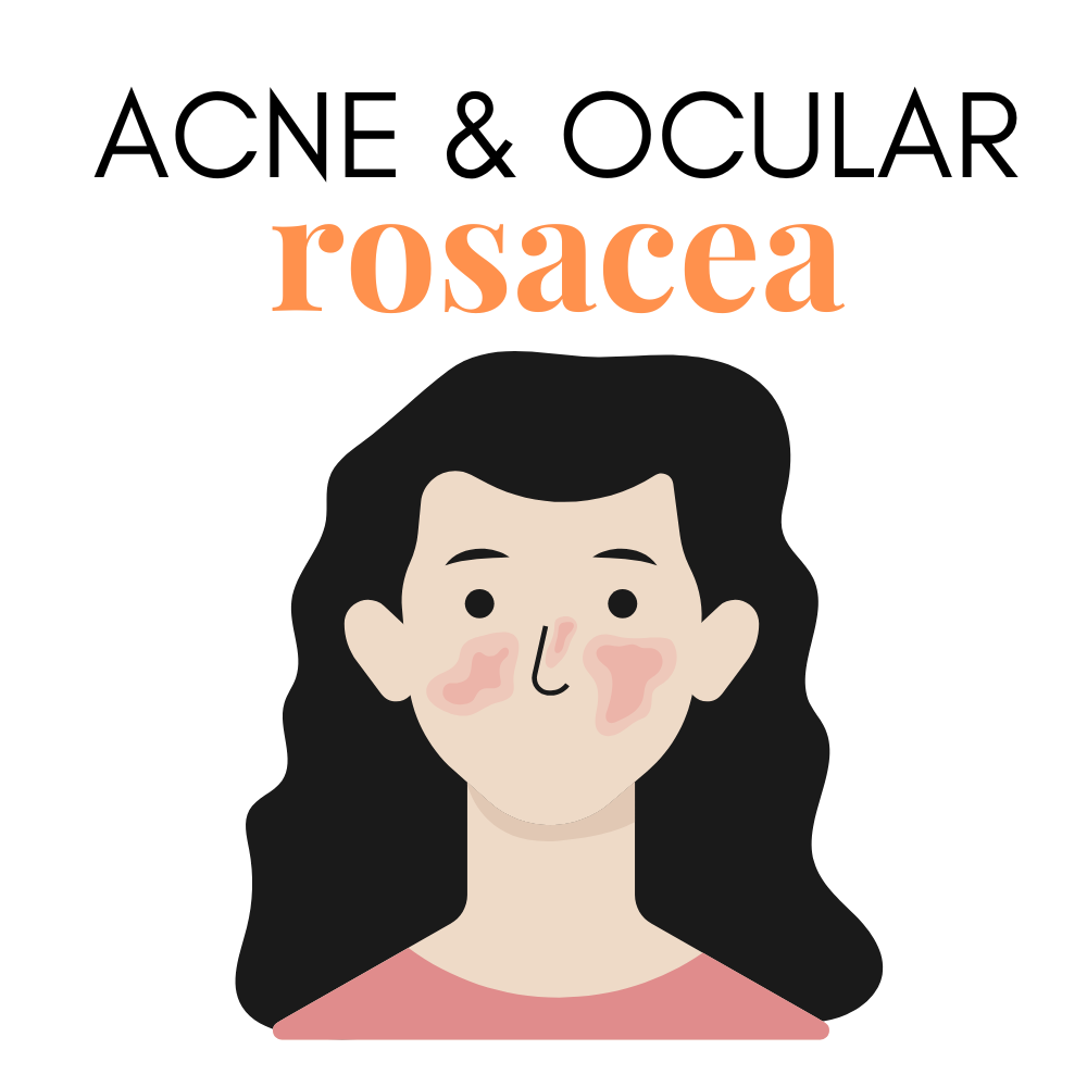 How Ocular Rosacea is Linked to Acne Rosacea: Understanding Causes, Sy ...