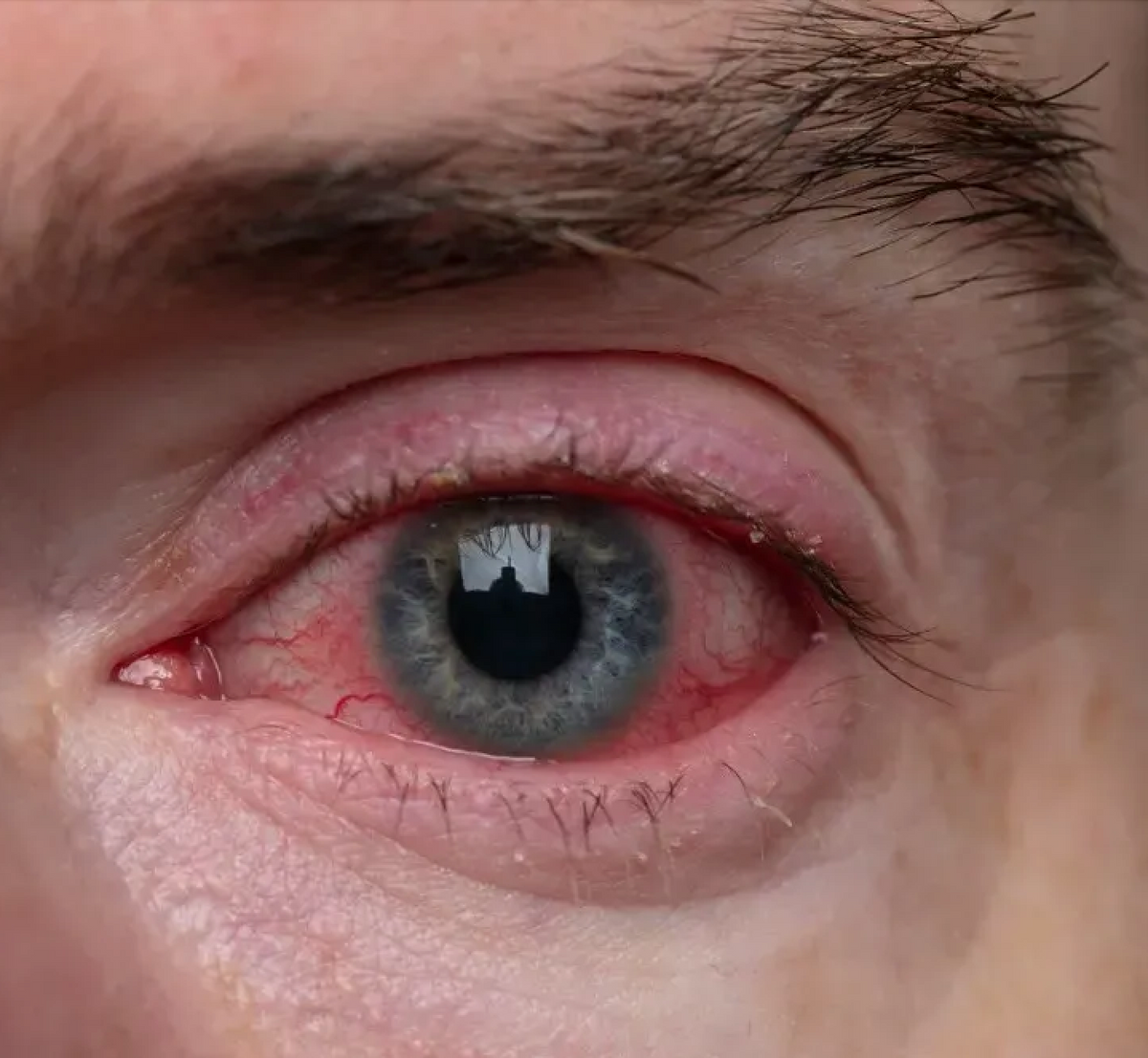 Tired of Blepharitis and MGD Frustrations? Here’s Your Next Move – We ...